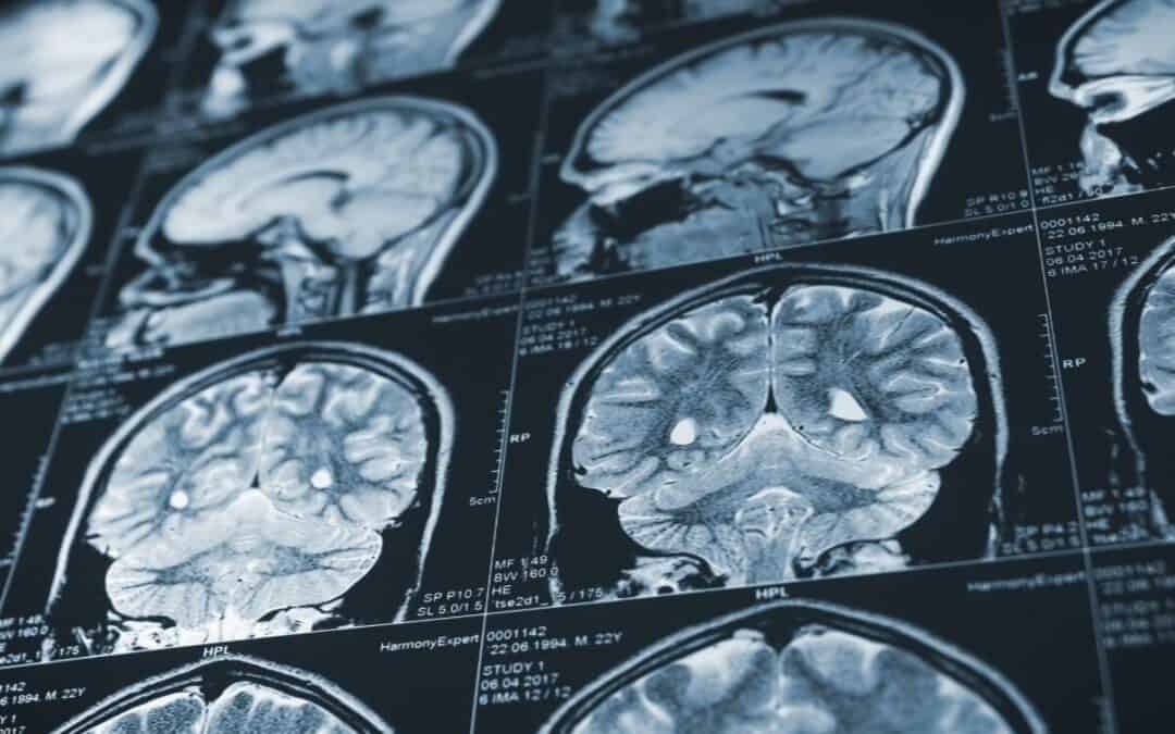Proving Negligence in Brain Injury Cases | JSBNI
